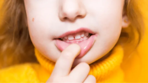 Common Bite Problems in Children and How They Are Treated - droidkit